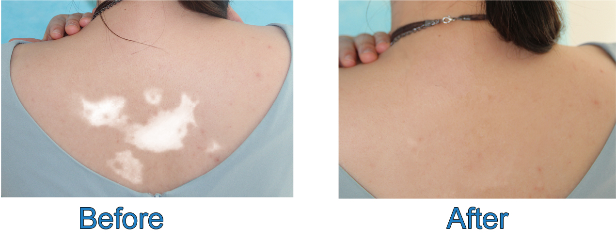 Vitiligo / White Spot - EXPERT Innovative Cure